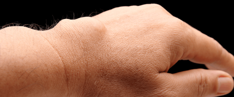 Tumeur de la main – MEDLASNE